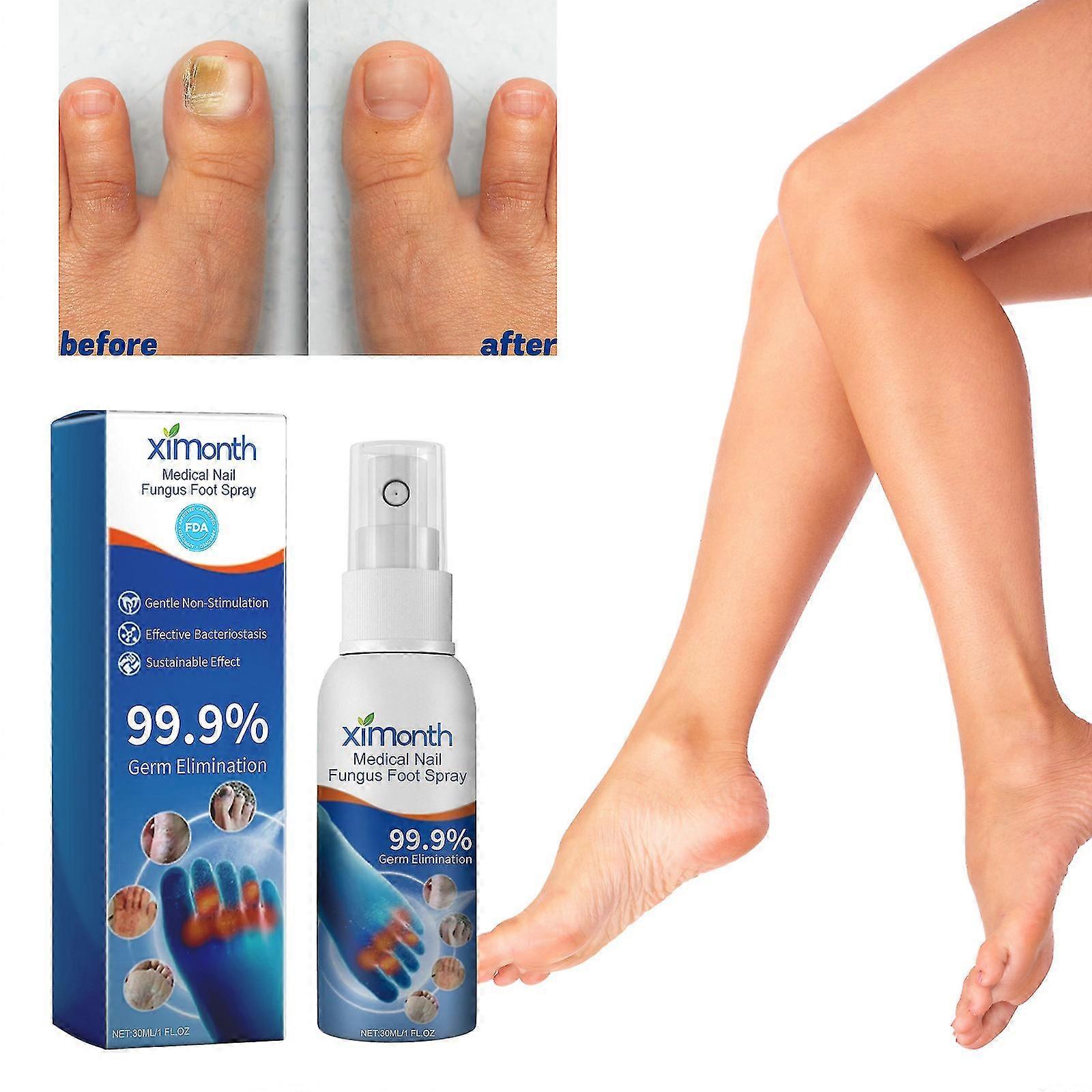 Medical Nail Fungus Foot Spray, Herbal Care Medical Grade Nail Foot ...