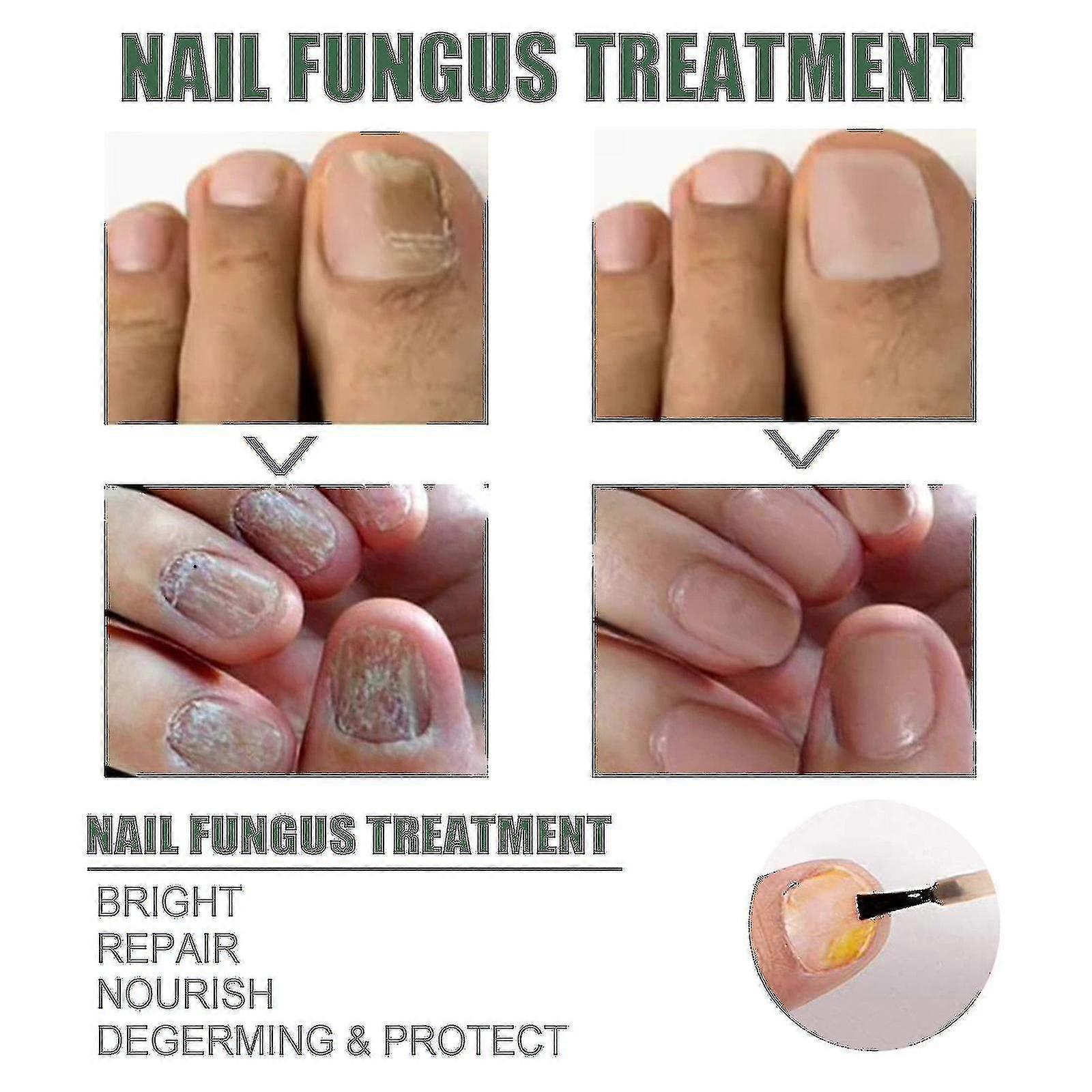 Extra Strong Nail Fungus Treatment, Best Nail Repair Stop Fungal Growth ...
