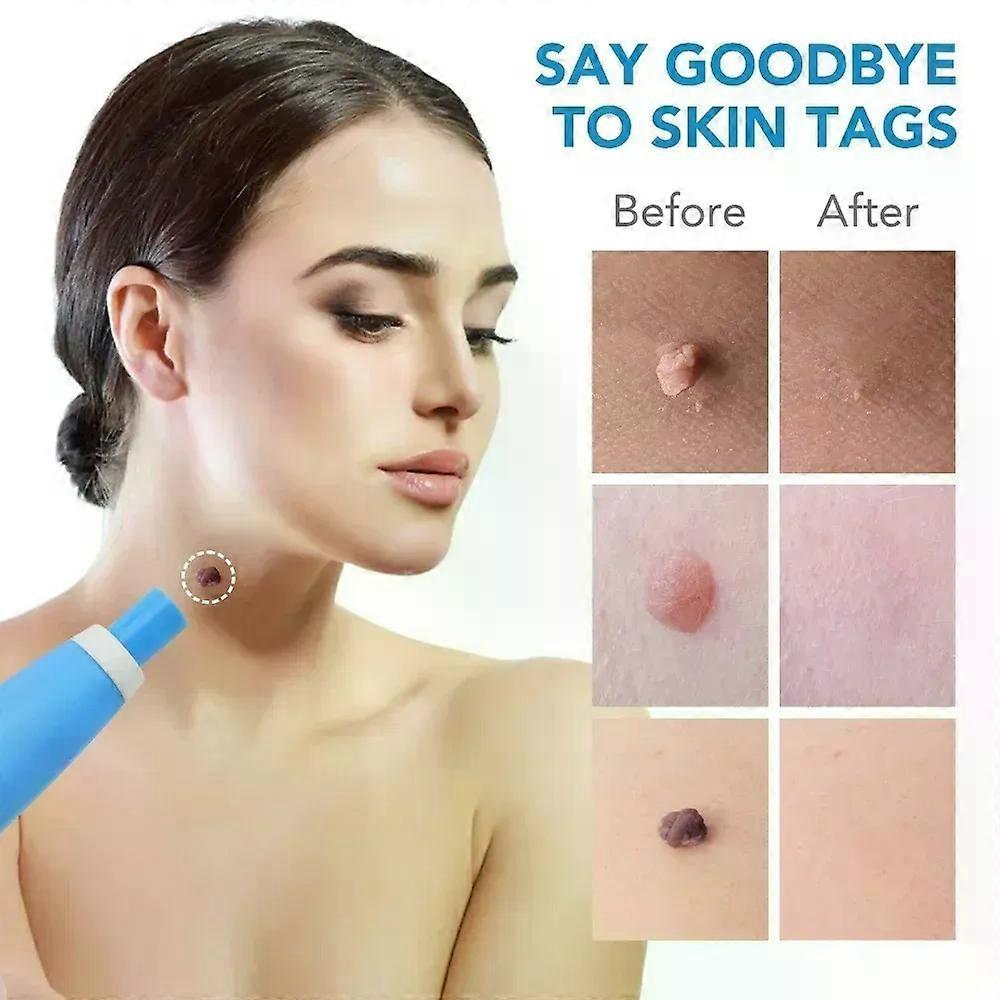 2 In1 Painless Auto Skin Tag Mole Wart Removal Kit Cleaning Tools Face ...