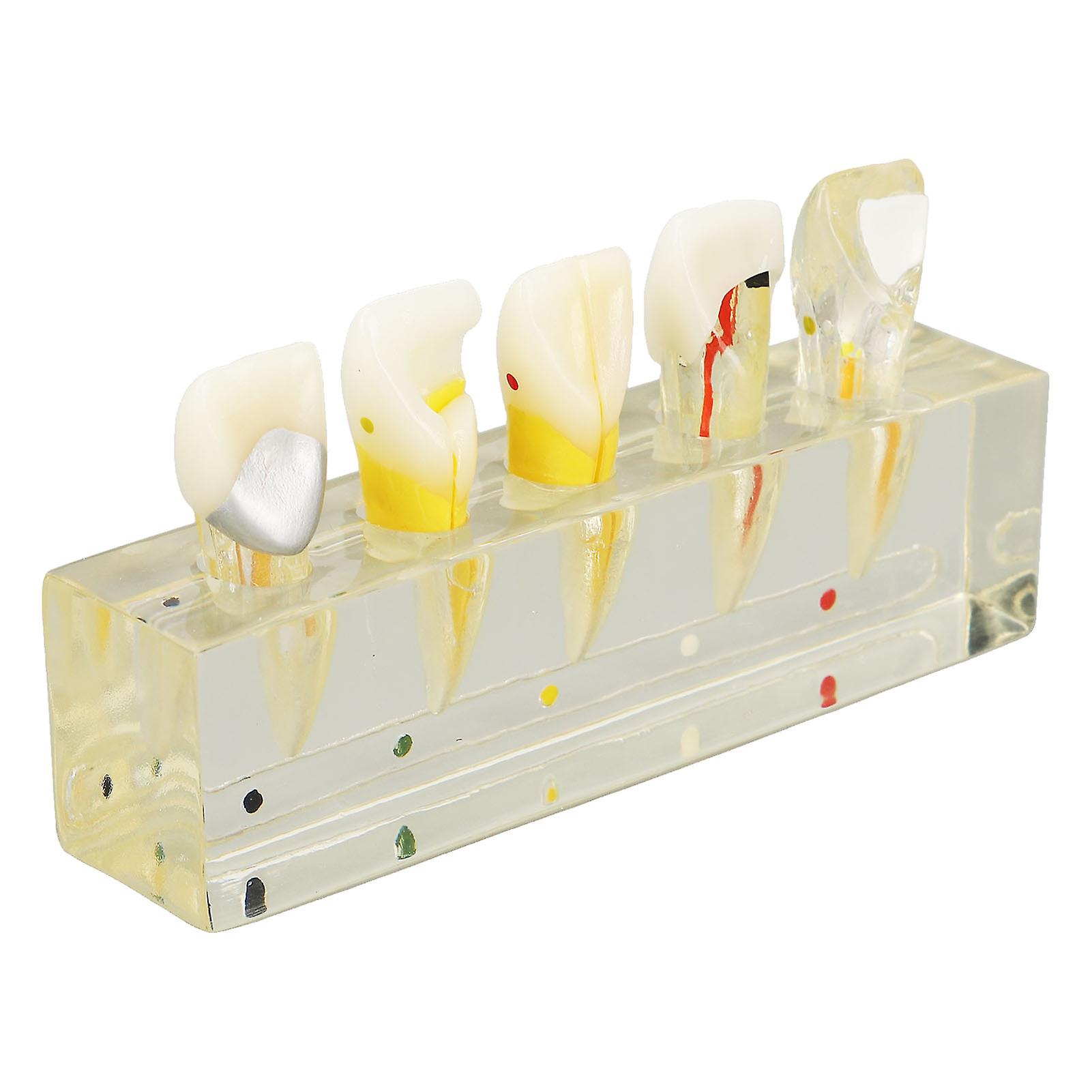 Dental Pulp Cavity Model Dental Hospital Resin Endodontic Teeth Model ...