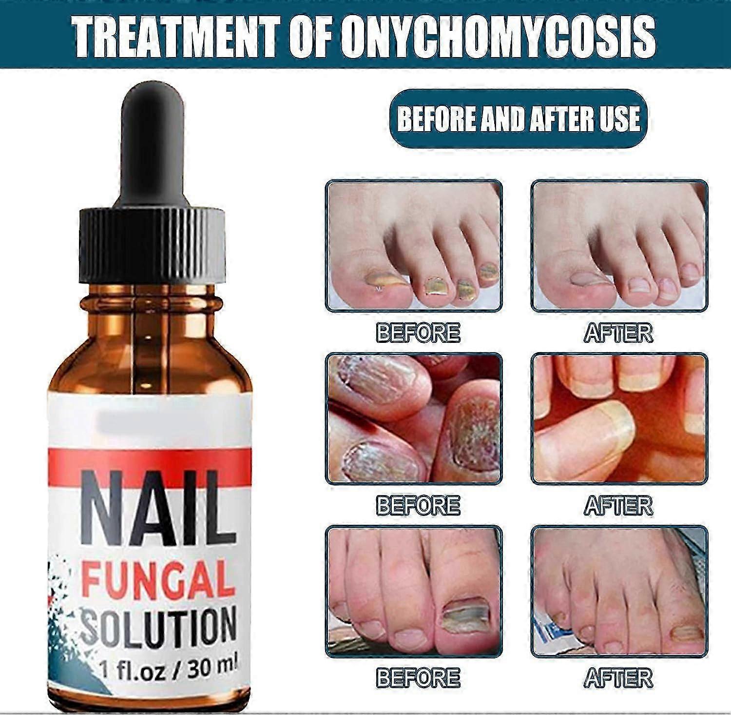 Nail Fungal Solution,Nail Repair for Fingernails Toenails, Toe Nail ...