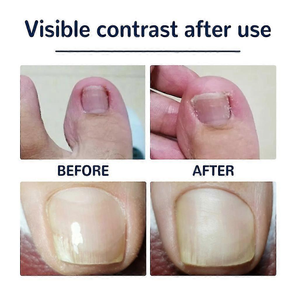 Nail Correction Stickers Ingrown Toenail Corrector Patches Paronychia ...