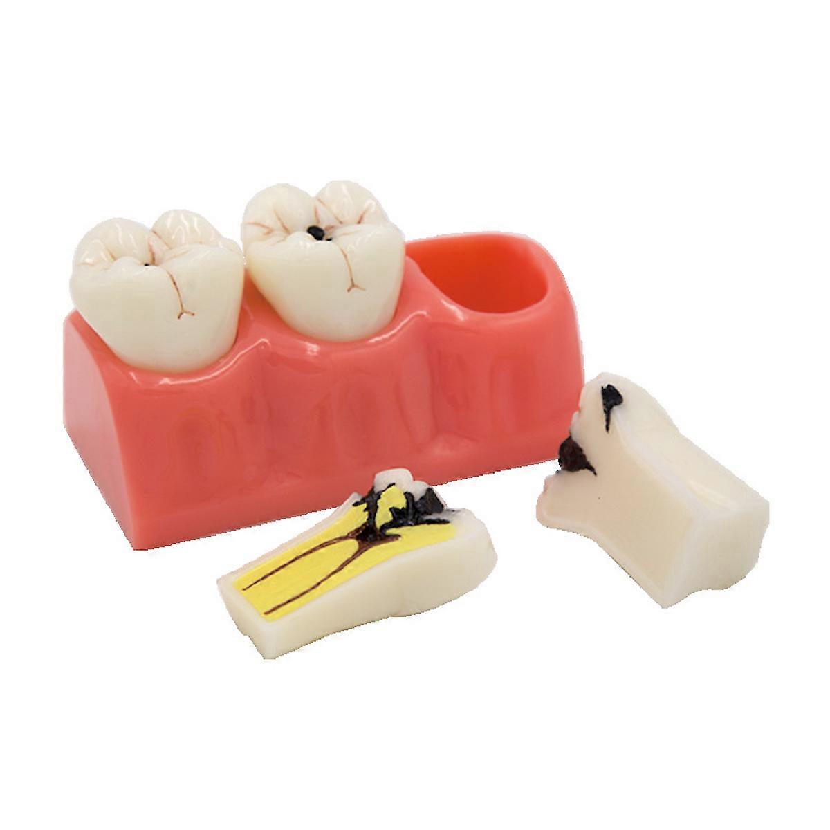 Tooth Decay Model Tooth Lesions Four Times Teeth Comprehensive ...
