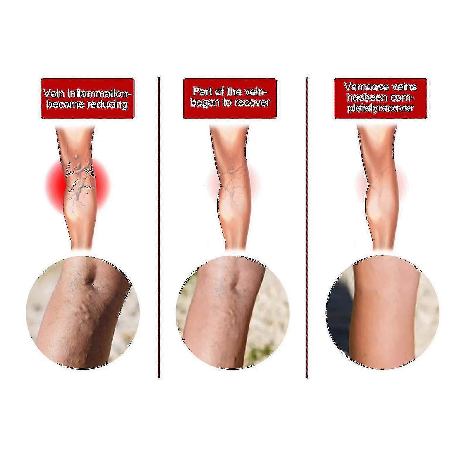 Varicose Care Herbal Patch Leg Massage Relieve Soreness Earthworm Leg ...