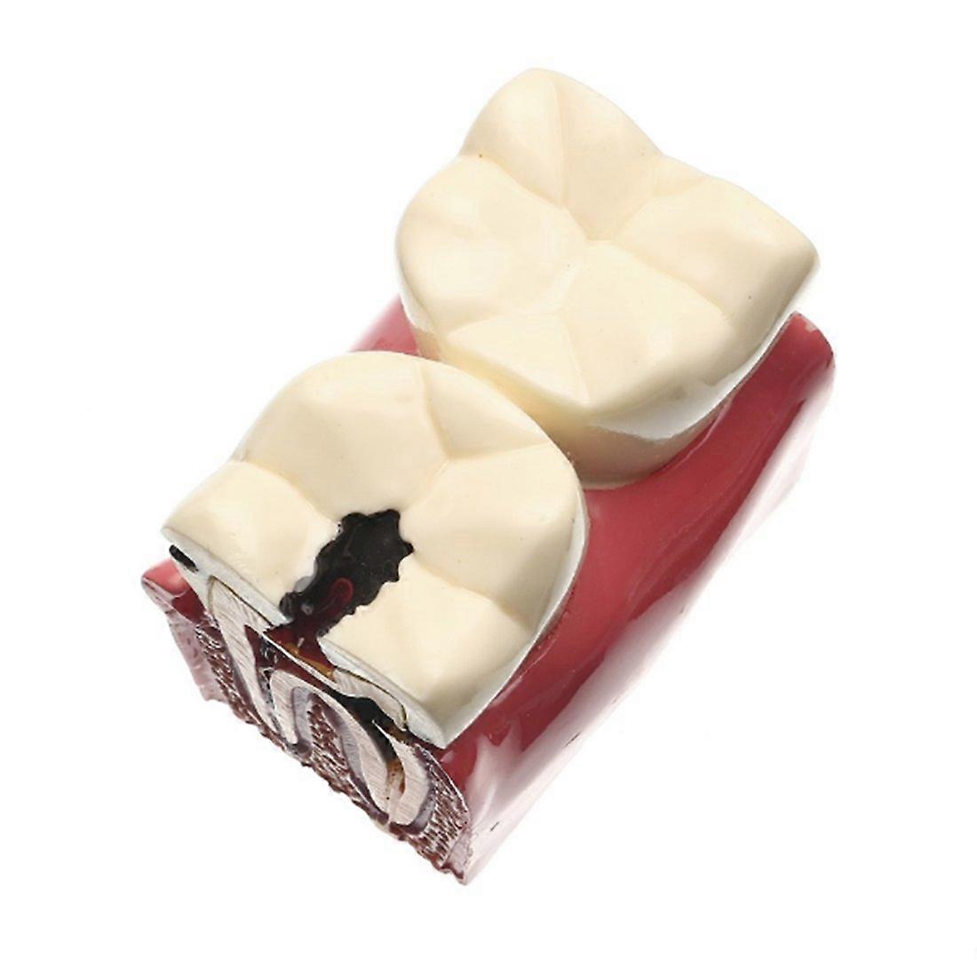 Dental Caries Tooth Model, YOUYA DENTAL Decay Teeth Comparative Study ...