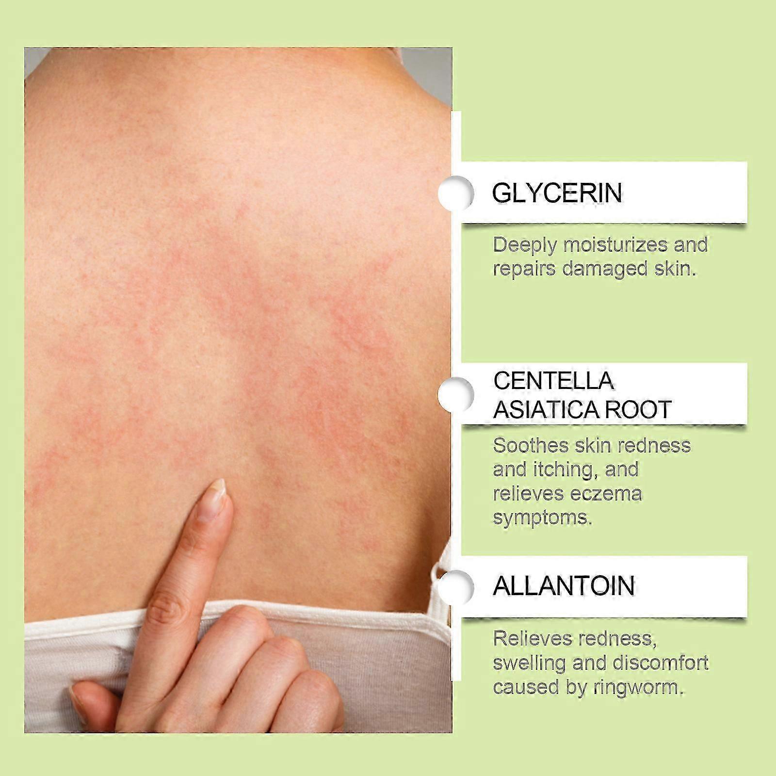 Ungüento herbal para el eczema, Crema para el eczema, Crema herbal para ...