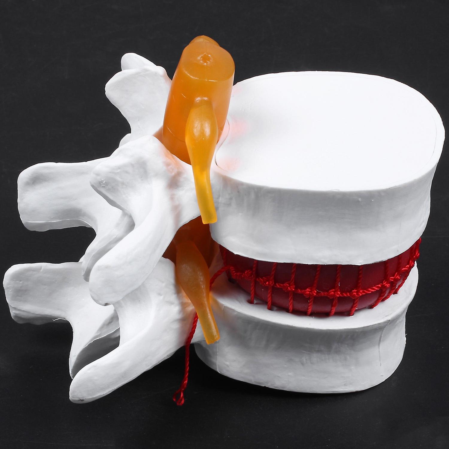 Human Anatomy Skeleton Spine Lumbar Disc Herniation Teaching Model ...