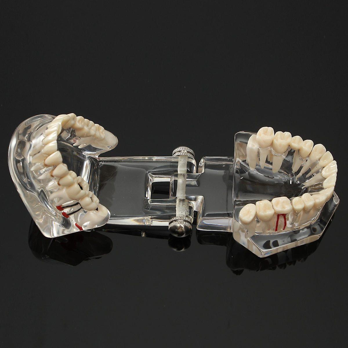 Implant Dental Disease Teeth Model With Restoration Bridge, Tooth ...