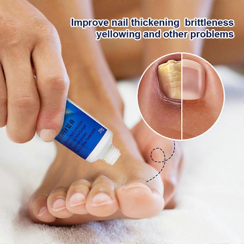 1/2/3PCS Fungal Nail Treatment Cream,strong Anti-fungal Toenail Cream ...