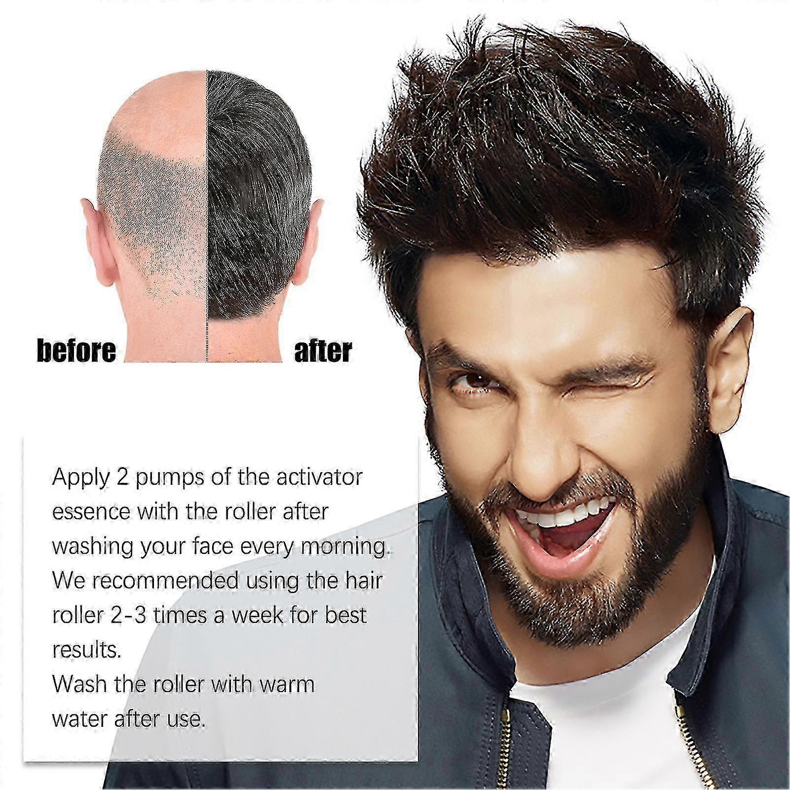 Jaysuing Hair Growth Roller Safe Painless Titanium Microneedle Roller Strong Root Nourish Scalp ...