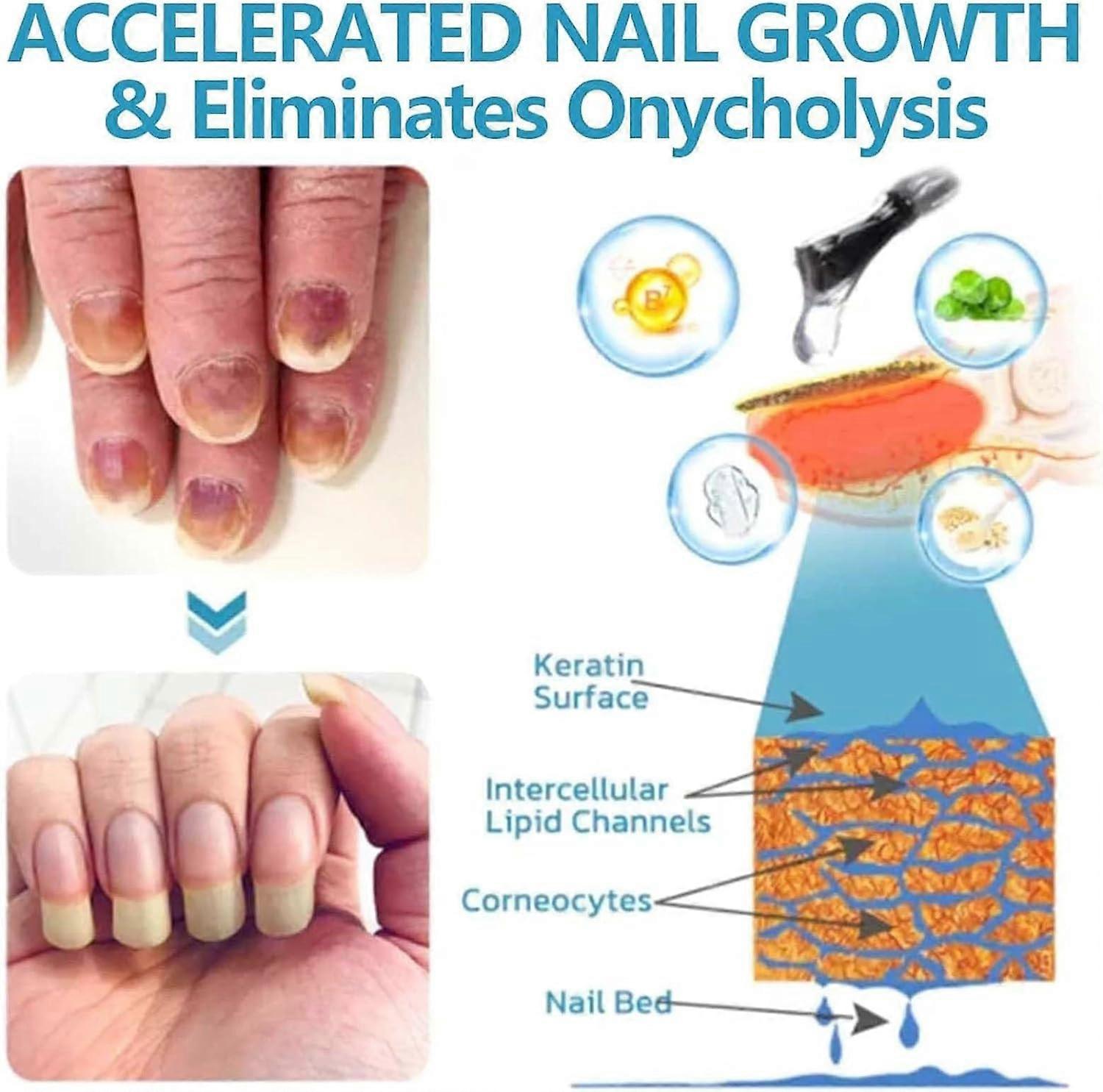 Nail Repair Serum, Intense Nail Growth and Strengthening Serum, Nail ...