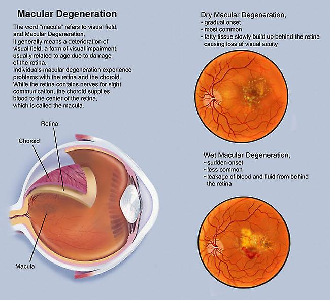 Retina with macular degeneration Poster | Fruugo UK