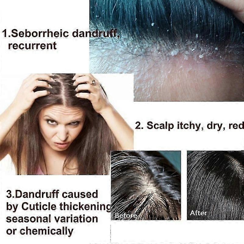 Natural Anti Dandruff Essential Oils Fast Get Rid Of Anti Dandruff Hair ...