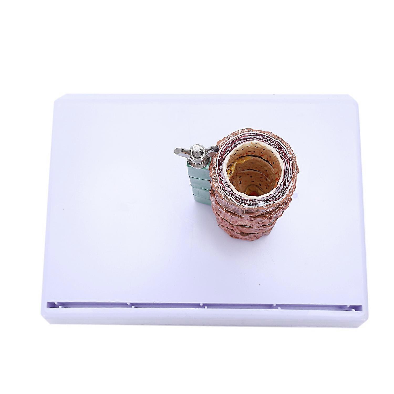 Atherosclerosis Thrombosis Model Vascular Disease Demonstration Heart ...