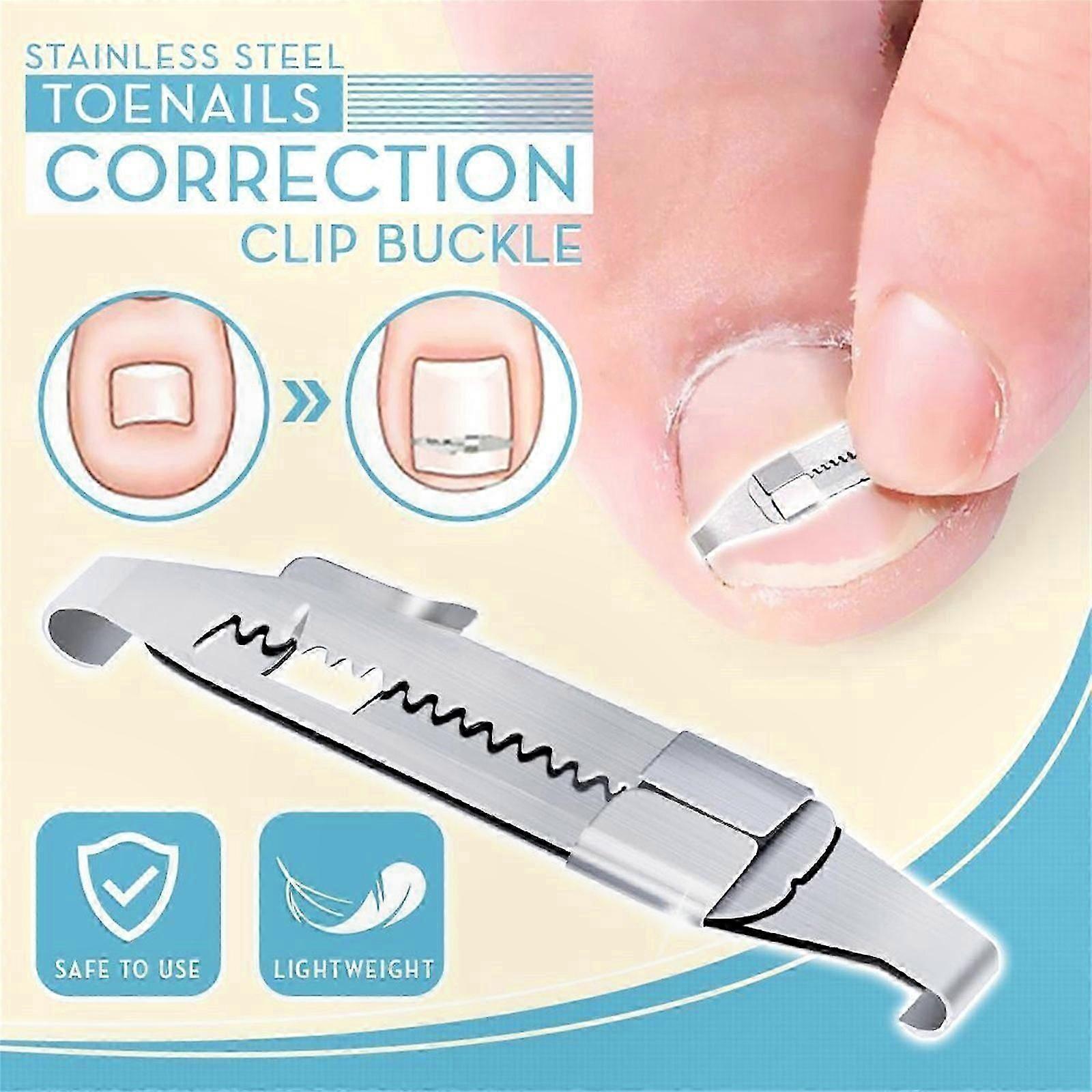 Toenail Correction Kit with Buckle and Groove for Ingrown Nail Support ...