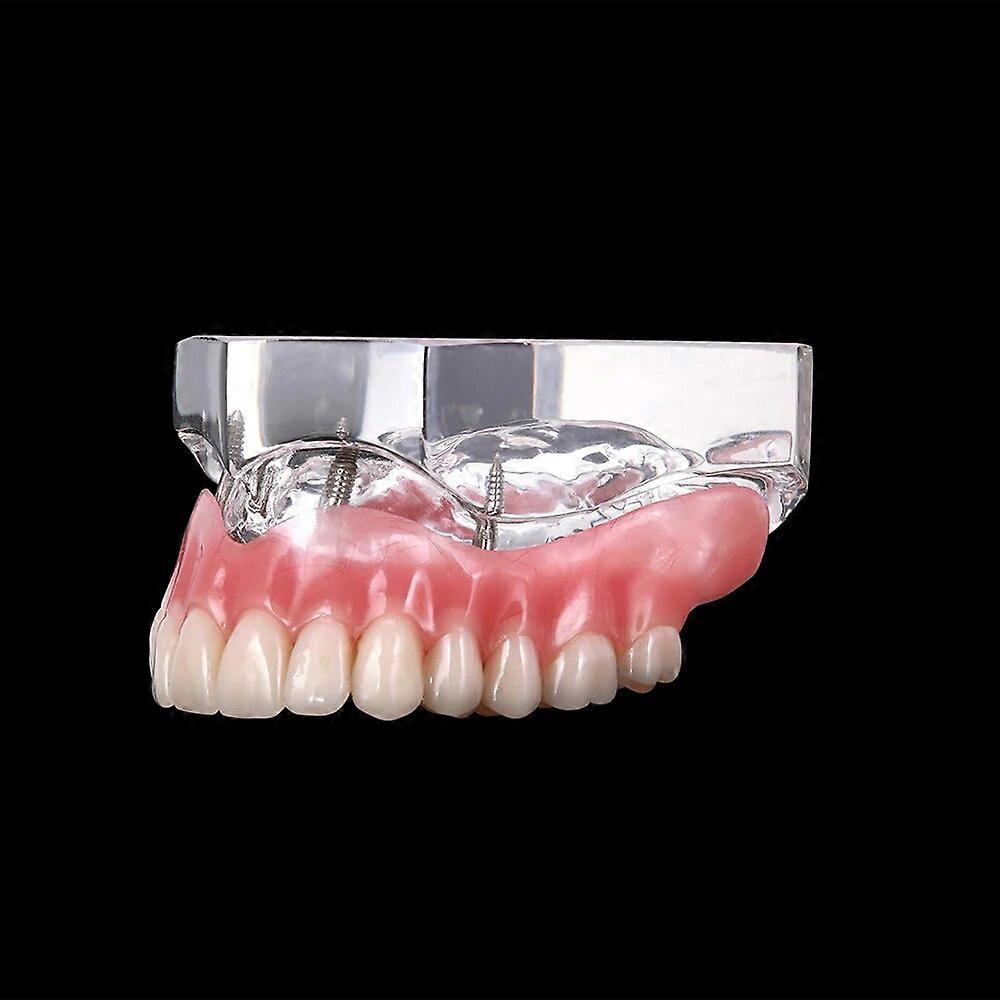 Dental Overdenture Teeth Dental Implant Teeth Model Demo Overdenture ...