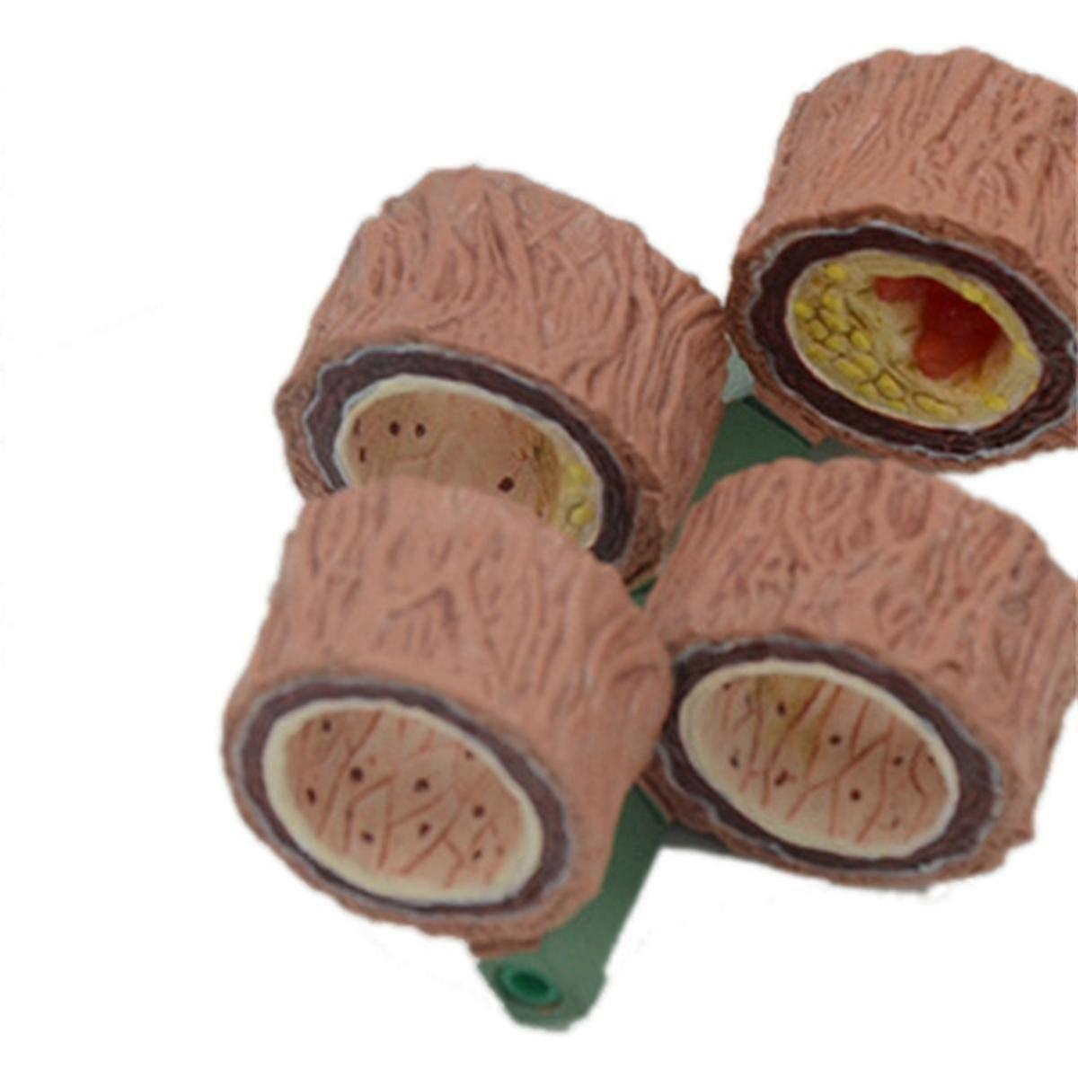 Human Body 4-Piece Artery Model, Anatomical Replica Model, Sclerosis ...
