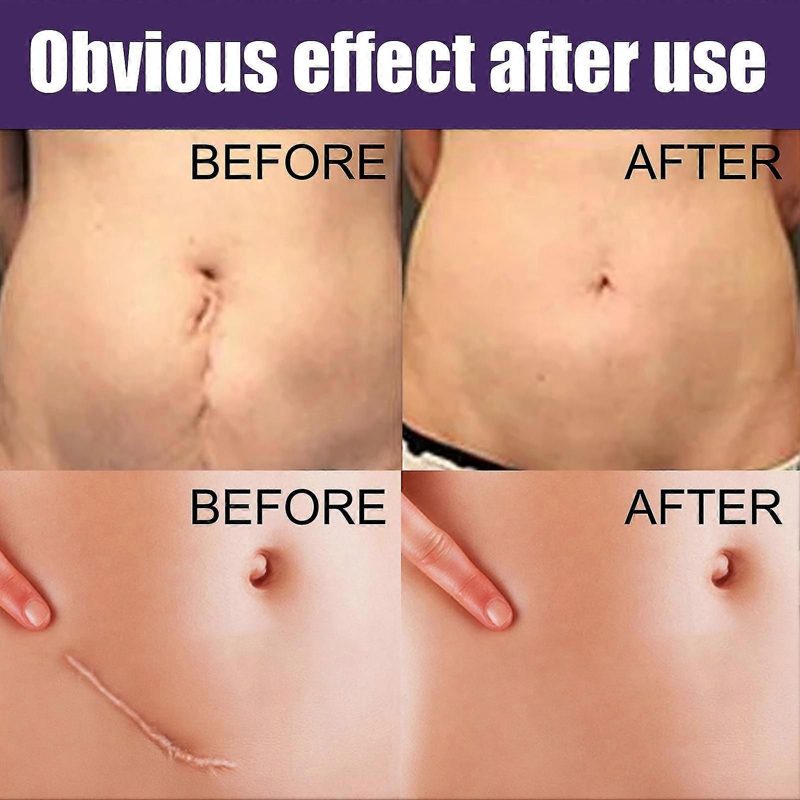 8 Pcs Silicone Scar Sheets Safety Mild Odorless Comfortable Fade Scars ...