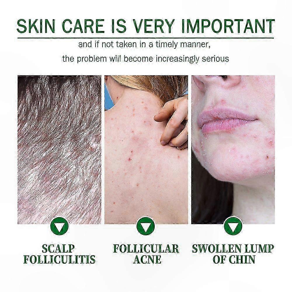Anti-Itch Scalp Treatment for Hair Follicle Inflammation & Skin ...