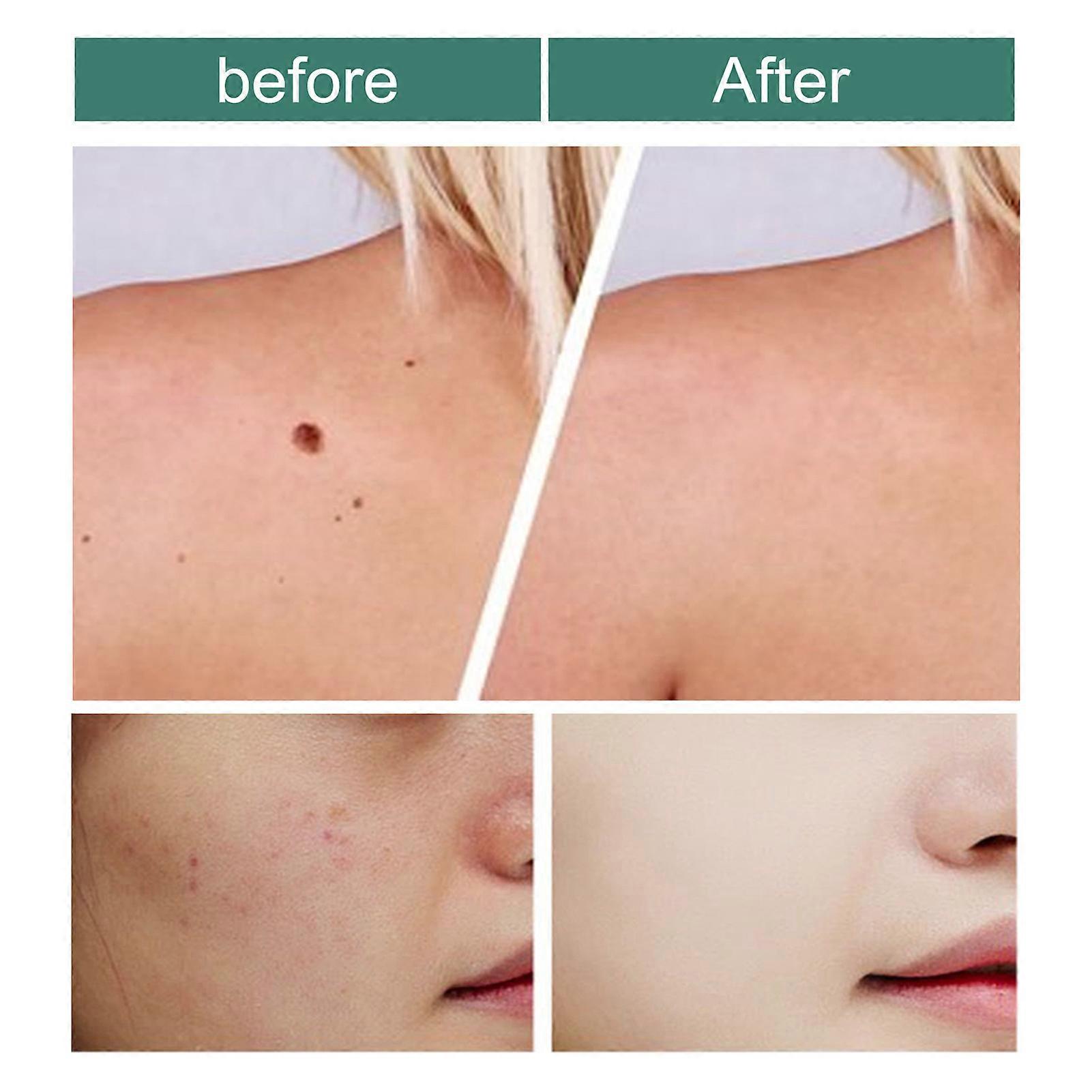 Vorter og ligtorne fjernelse væske Meget potent Vorte fjernelse ...