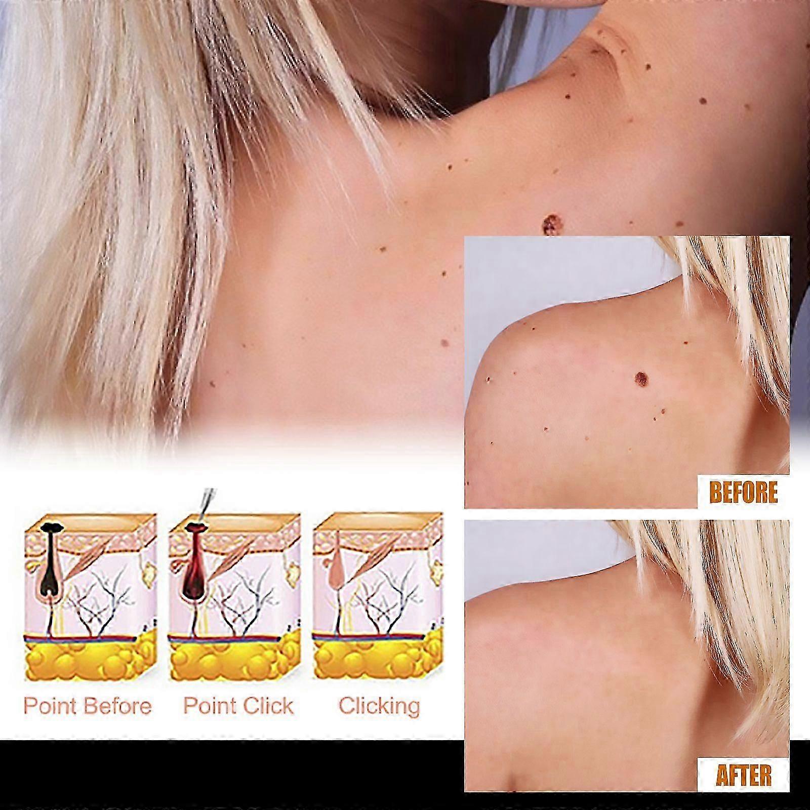 Anti-Wart & Mole Removal Essence - Gentle Cleansing Face & Neck Serum ...