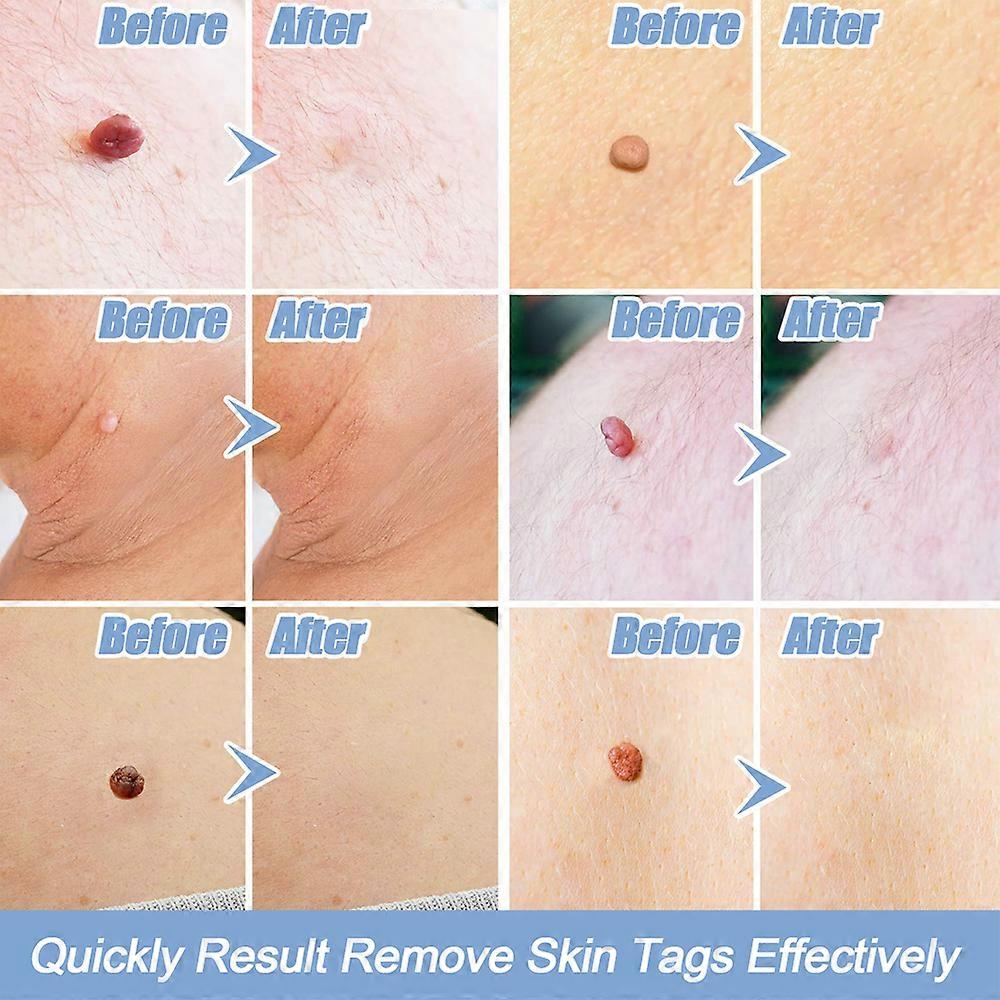 Remove Skin Tag Pen Facial Care Nevus Tool 2mm-4mm Remove Meat Nevus ...