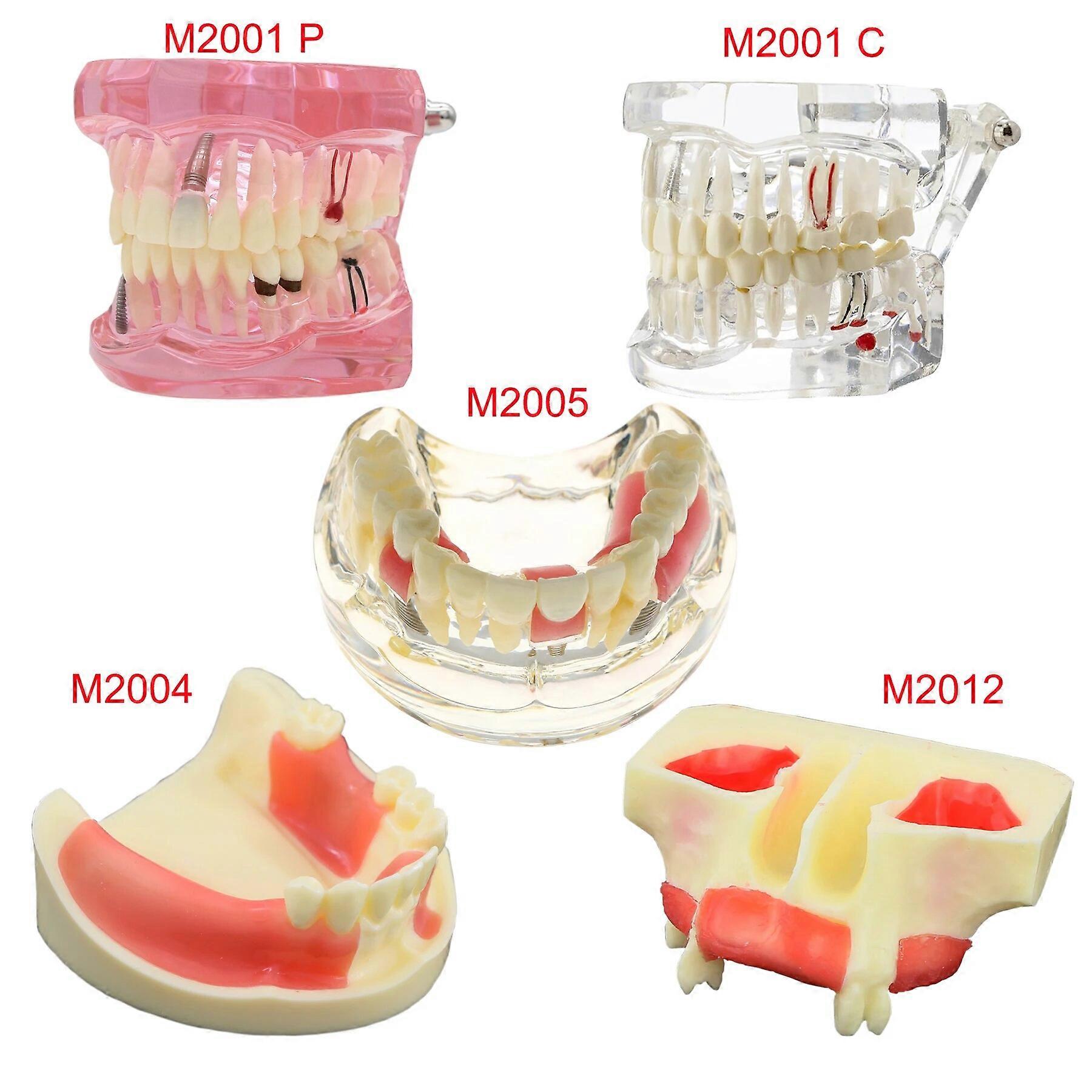 Dental Teeth Model Dental Teaching Models Implant Model Removable ...