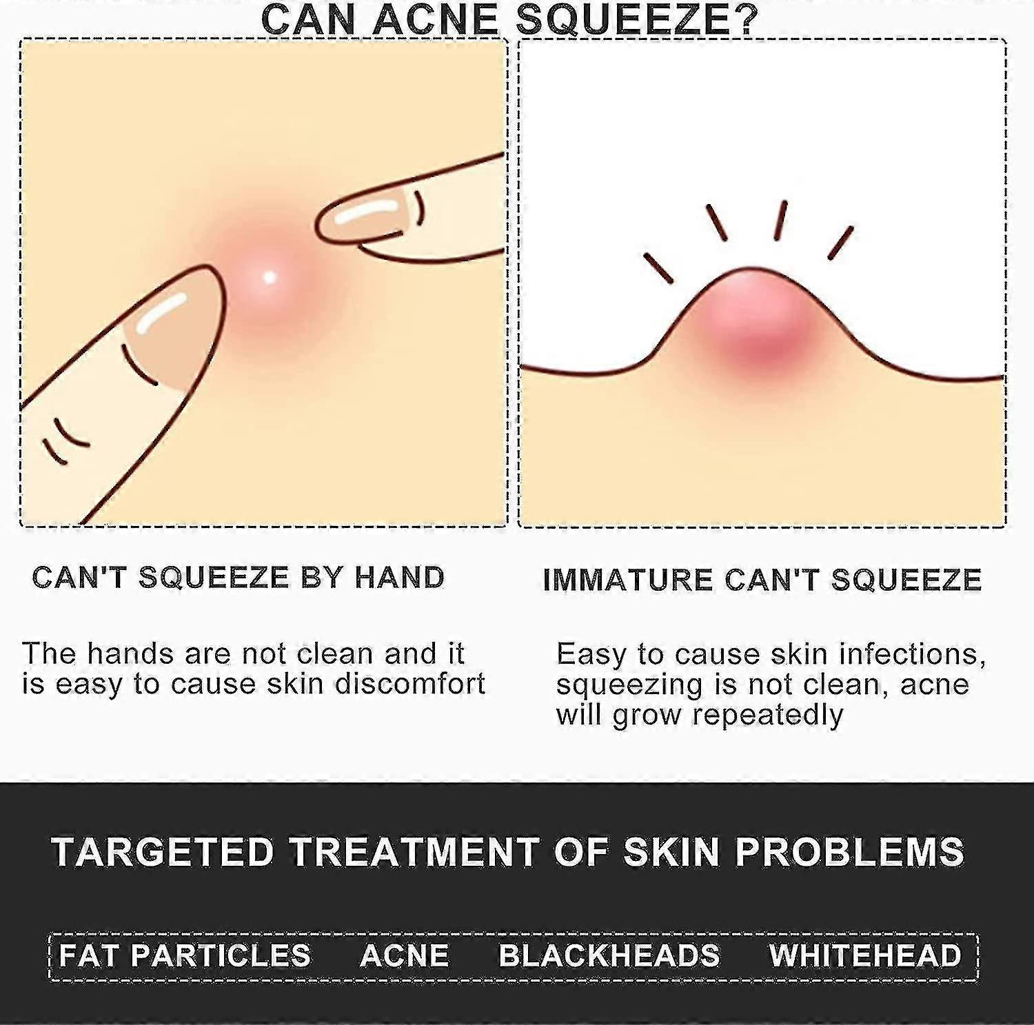 Professional Facial Milia Removal And Whitehead Extractor & Lancet ...