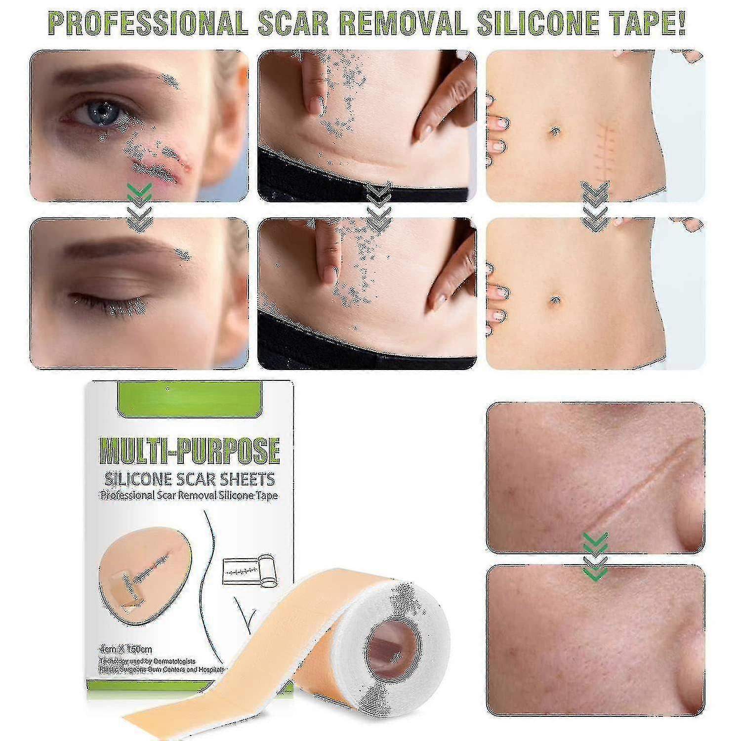 Silicone Plasters For Scars, Silicone Scar Plasters, Silicone Scar ...