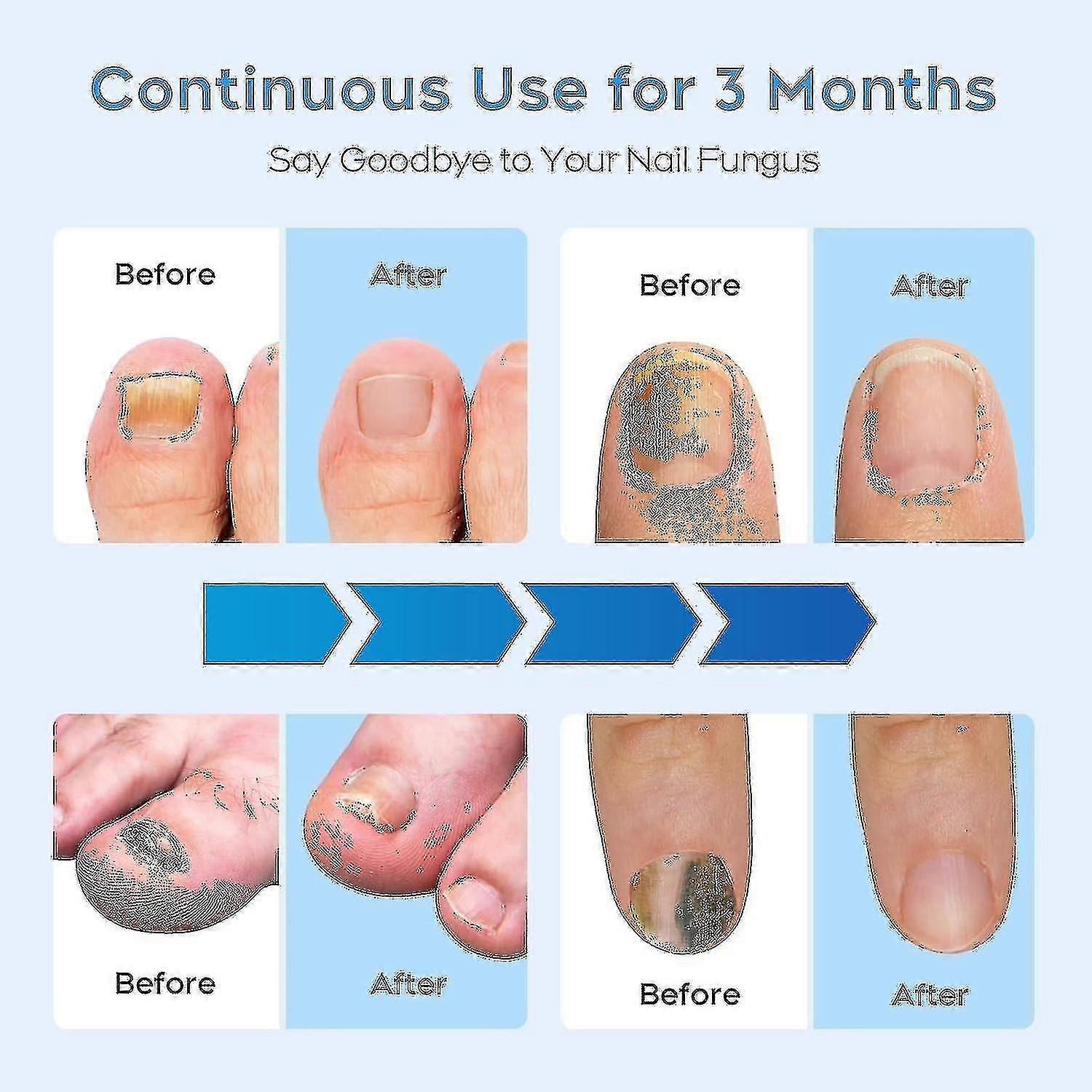 2024 Nail Fungus Laser Treatment Device for Multiple Toenail, Home Use ...