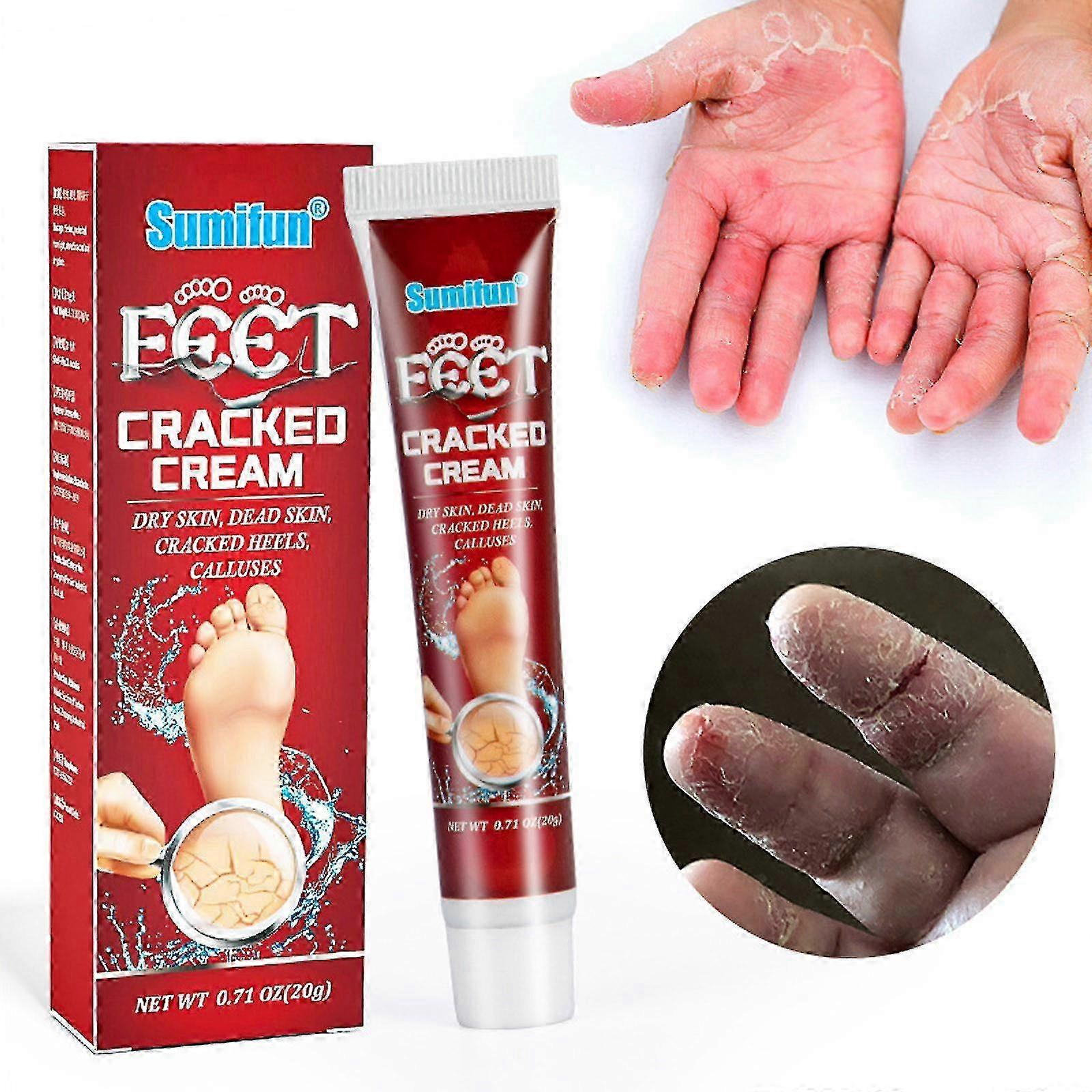 Cracked Hands And Feet Cream Dry Crack Anti-freeze Crack Crack Crack ...