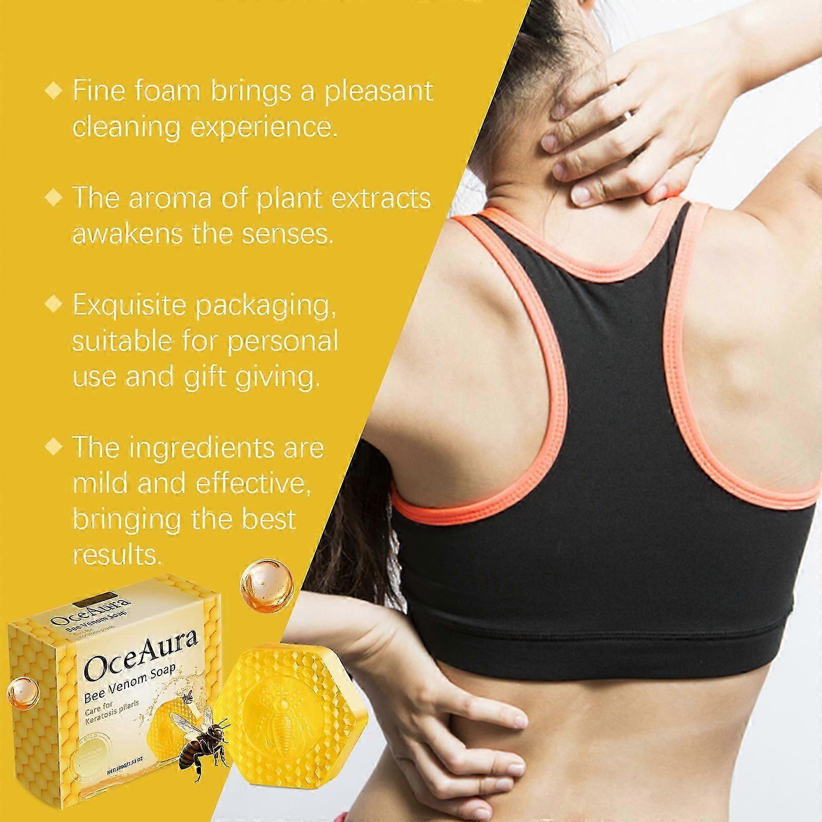 Keratosis Pilaris Bee Venom Soap, Keratosis Pilaris Soap, Keratosis Pilaris Bar Soap, Bee Venom ...