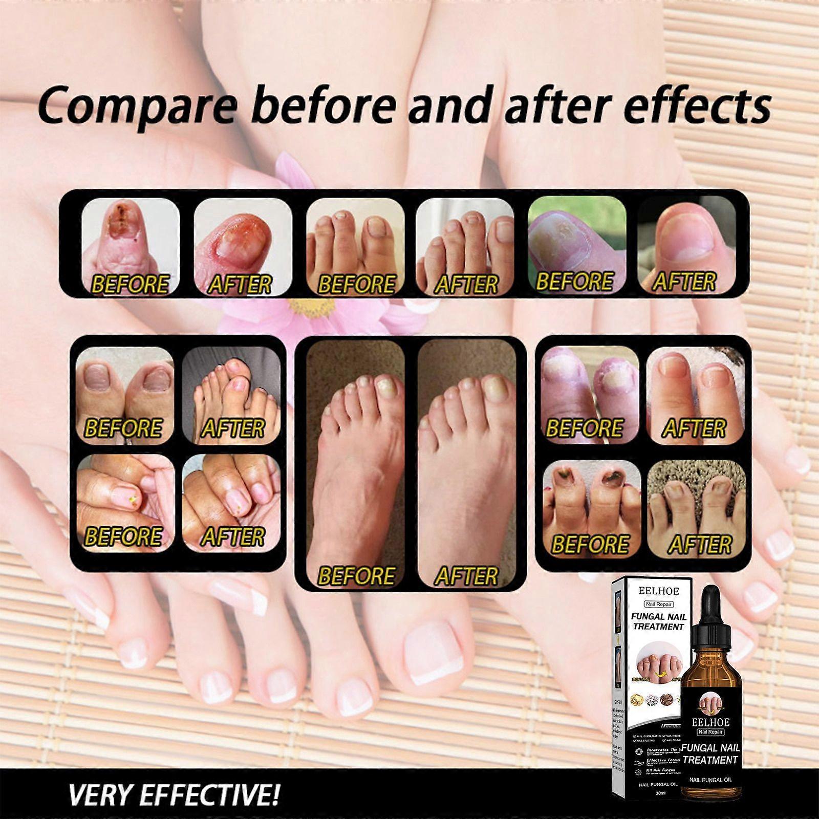 Nail Repair Solution Thickening And Brightening Nails Removing Gray ...