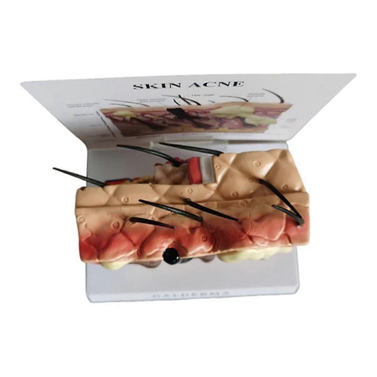 Skin Acne Model, Human Anatomy Normal Common Acne Skin, Physiology ...