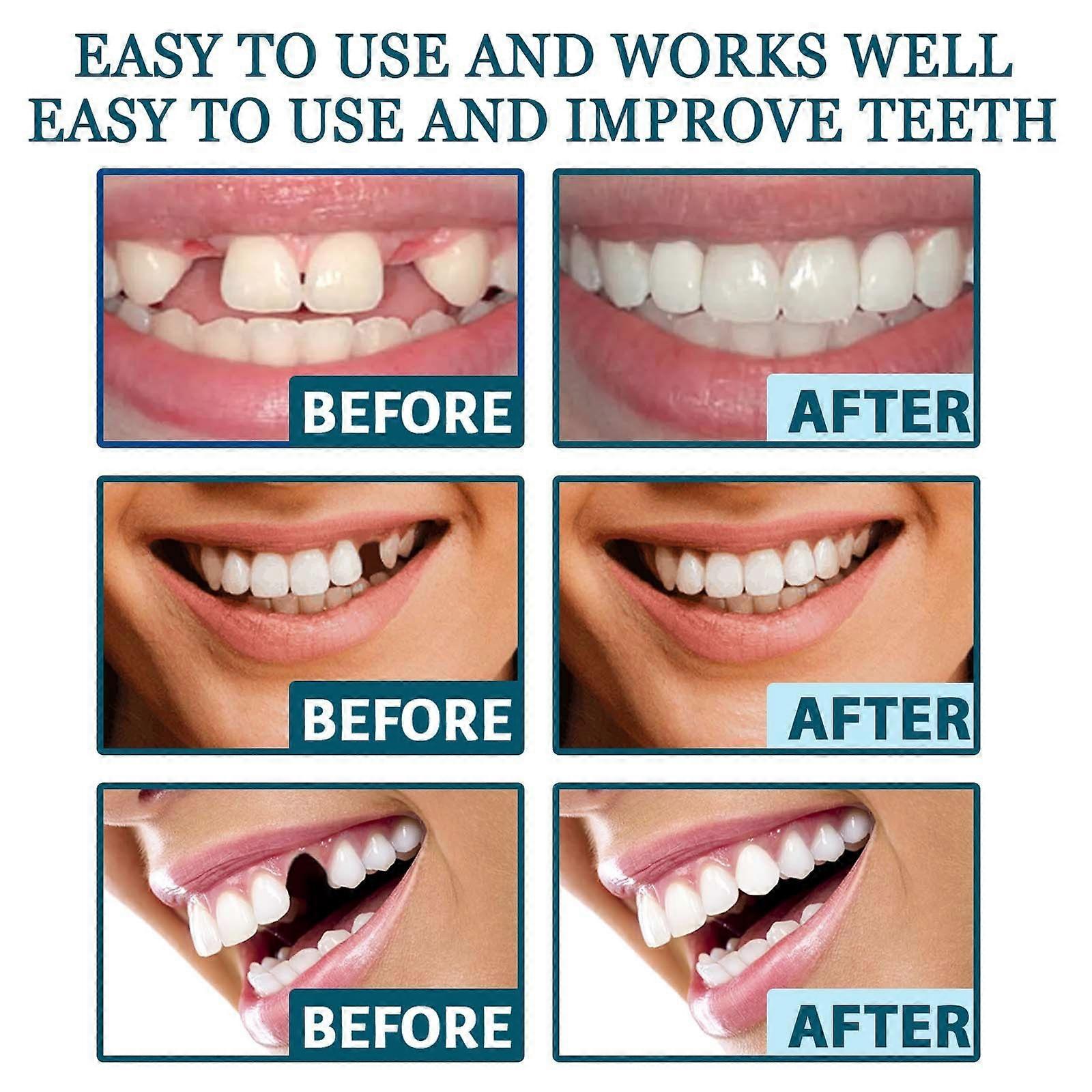 Dentures Teeth, Temporary Fake Teeth Snap On Smile Tooth for Women Men ...