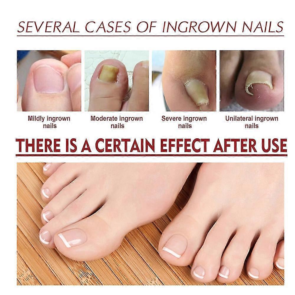 3x Nail Helper Ingrowth Toenail Correction Treatment Oil, Paronychia ...
