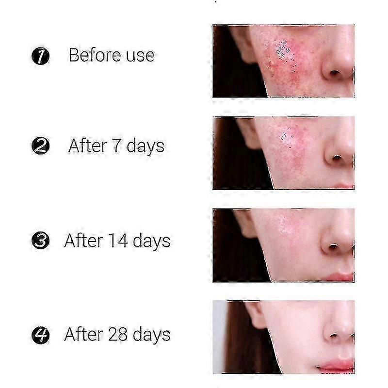 Anti-acne Cream Treatment Cream Blackhead Acne Cream Repair Gel Oil Control Shrink Pores Scar ...