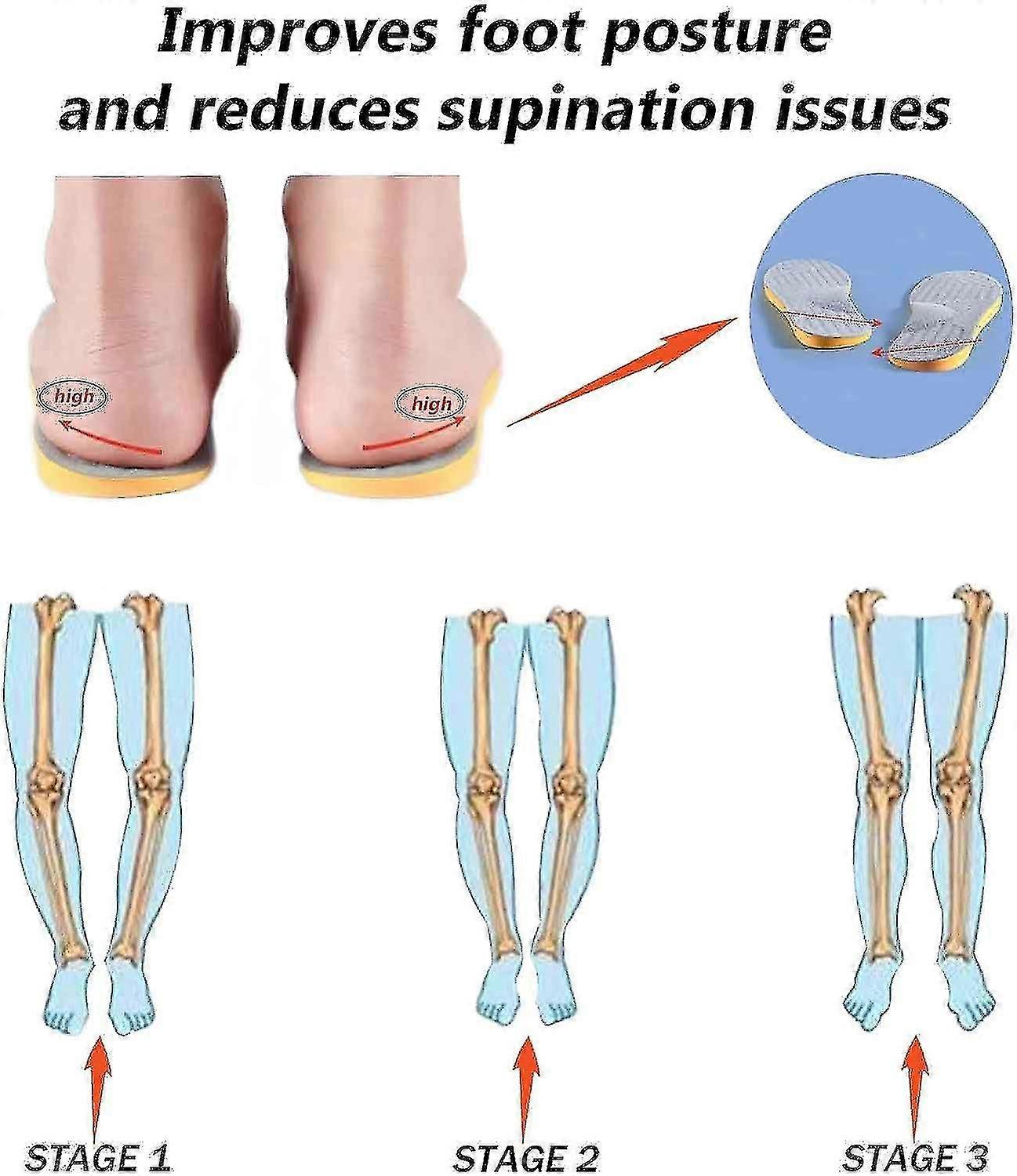 Supination Insoles For Over Supination & High Arch Support, Orthotic ...