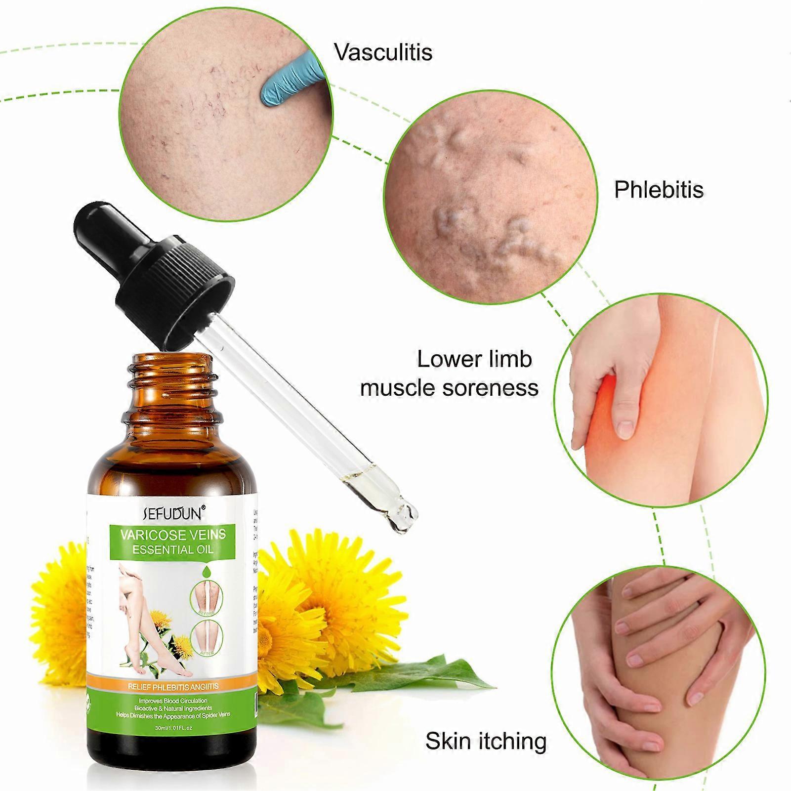 Varicose Veins Treatment Serum Varicosity Angiitis Remedy Ointment ...