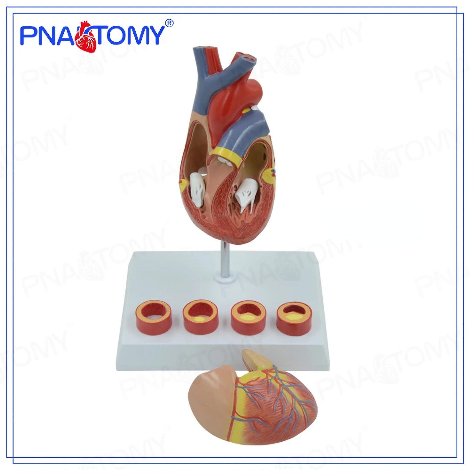 Kx-a401 Heart Model 4-stage Vascular Artery Pathological Stage Cardiac ...