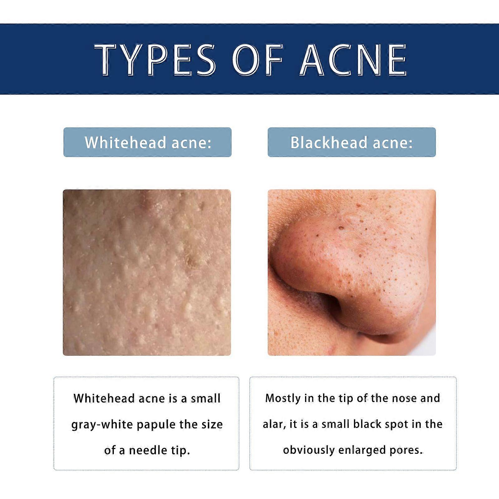 Anti-Pimple Drying Lotion, Facial Cleansing And Repair Lighten Acne ...