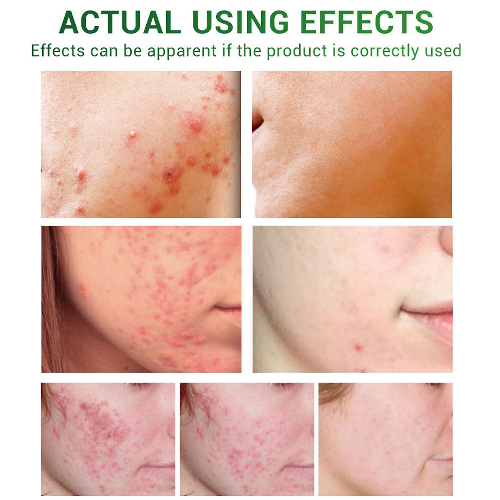 Acne Treatment Essence Tea Tree Oil Clear Skin Essence for Clearing ...