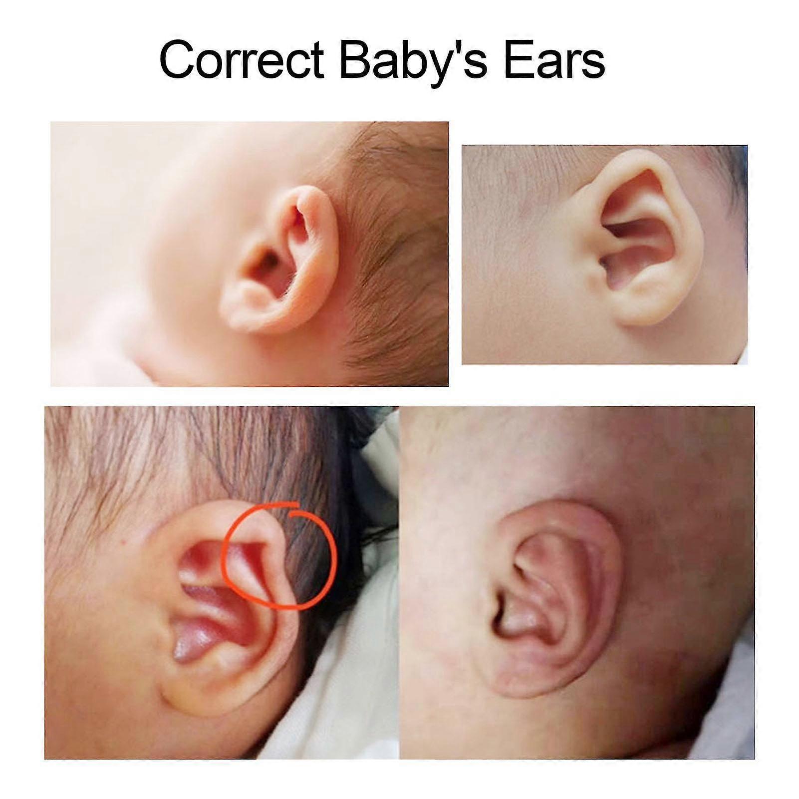 Baby Ear Aesthetic Corrector Infant Protruding Ears Correction 4 x 50cm ...