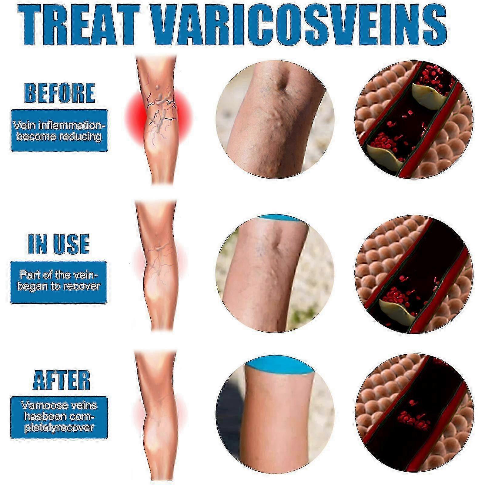 Varicose Vein Massage Spray 30ml Smoothing Vascular Bumps Smoothing ...
