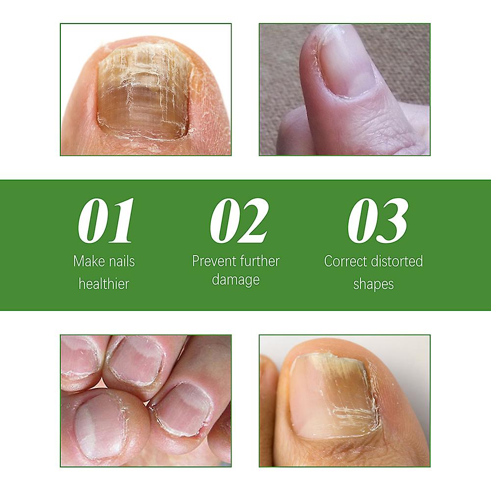 10ML Health Toenail Stick Roller Bead Onychomycosis Care Solution for ...