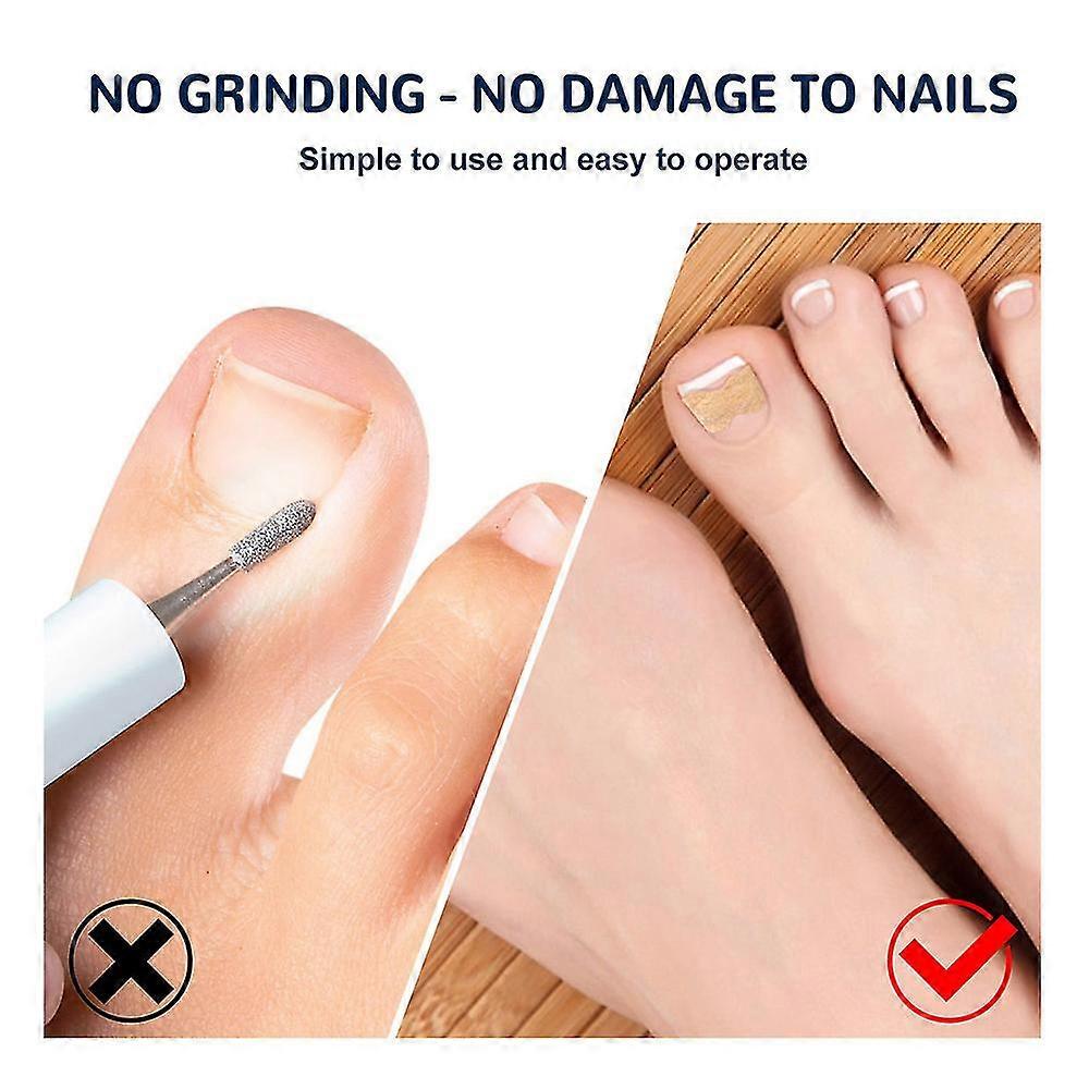 Nail Correction Stickers Ingrown Toenail Corrector Patches Paronychia ...
