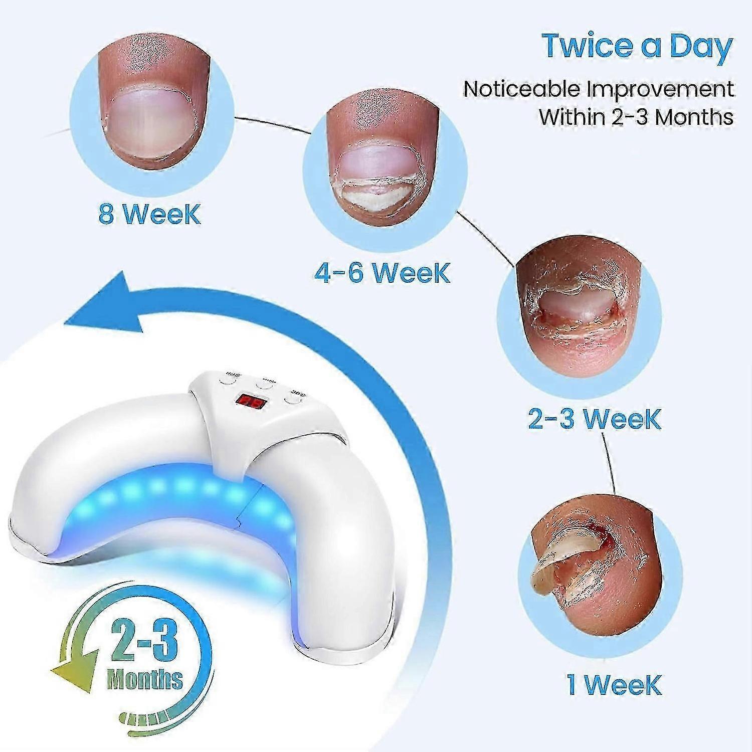 Nail Fungal Laser Device, Nail Fungus Treatment for Toenai, Laser ...