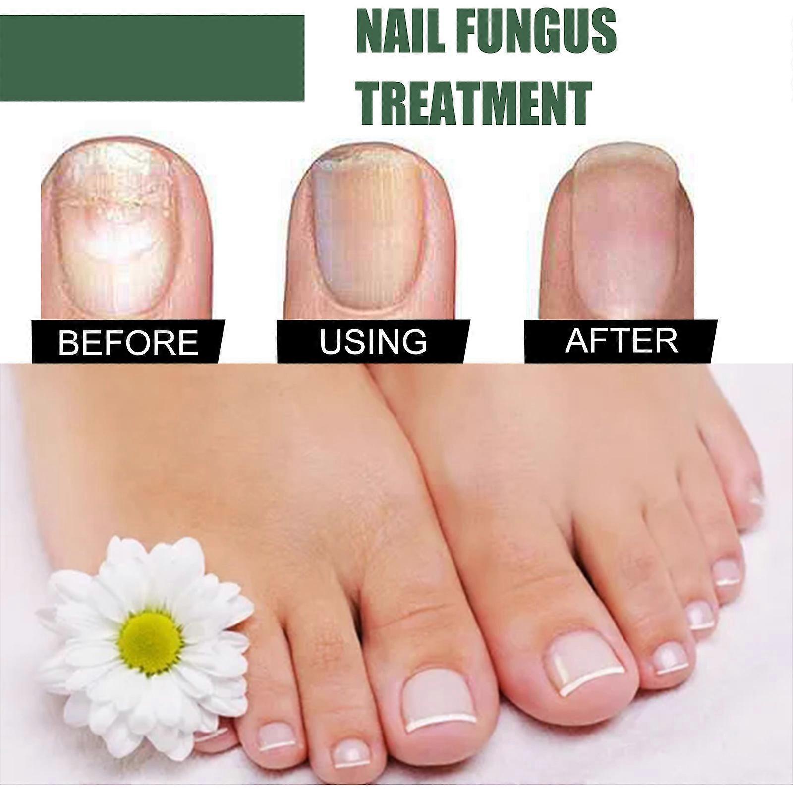 2set Extra Strong Finger & Toenail Fungus Treatment - Best Nail Repair Set, Fungi Fingernail ...