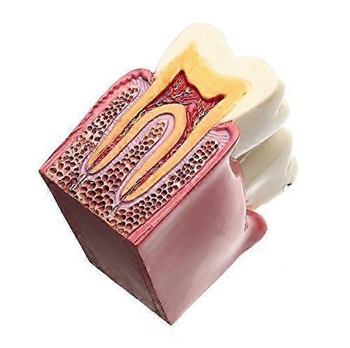 Dental Caries Tooth Model, YOUYA DENTAL Decay Teeth Comparative Study ...