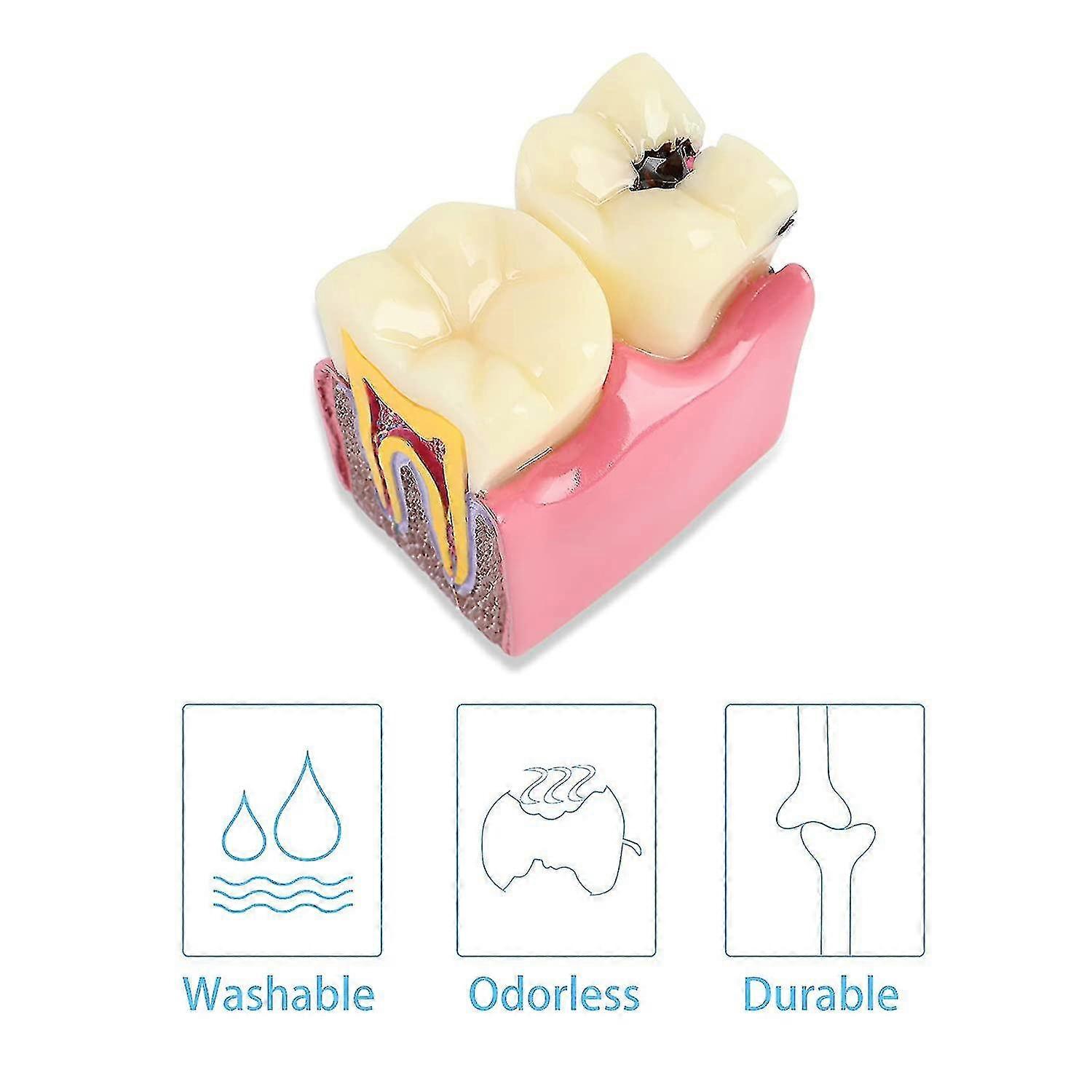 Dental Caries Tooth Model 6 Times Decay Teeth Comparative Study Model ...